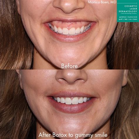 Gummy Smile Botox San Diego Cosmetic Laser Dermatology