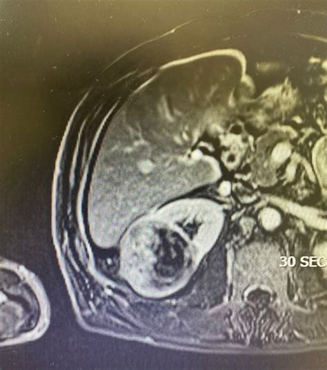 Thuchchai Pipitpanpipit On Linkedin Q Partial Vs Radical Nephrectomy