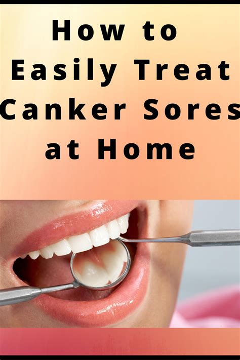 Canker Sores And Home Remedies For Treatment Artofit