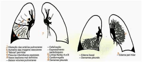 Profrogério Ultra Edema Pulmonar E CongestÃo Aspectos Radiológicos