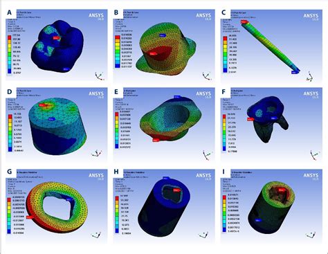 Figure 1 From Comparative Finite Element Analysis Of Endocrowns And Traditional Restorations For