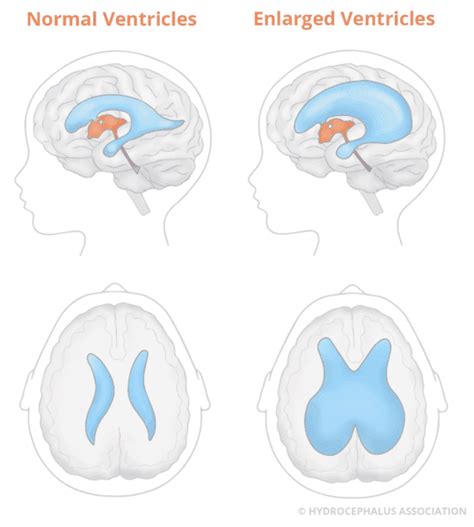 Hydrocephalus In Adults Learn About The 4 Categories