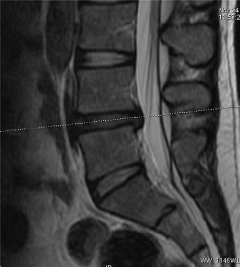 A Sagittal T 2 Weighted Mri Image Of Lumbar Spine Of A Patient With 8