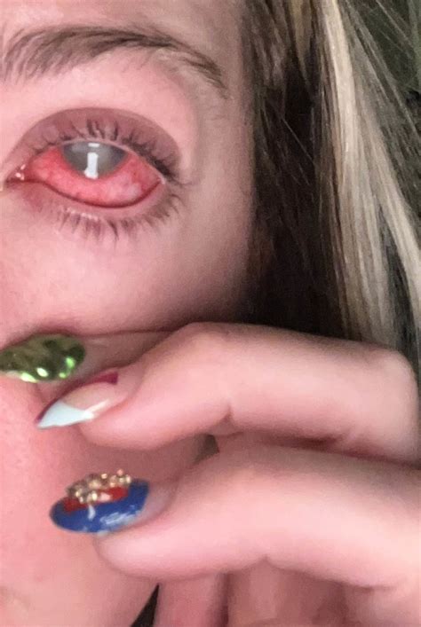 Woman 23 Fights Parasitic Eye Infection After Swimming In Contacts