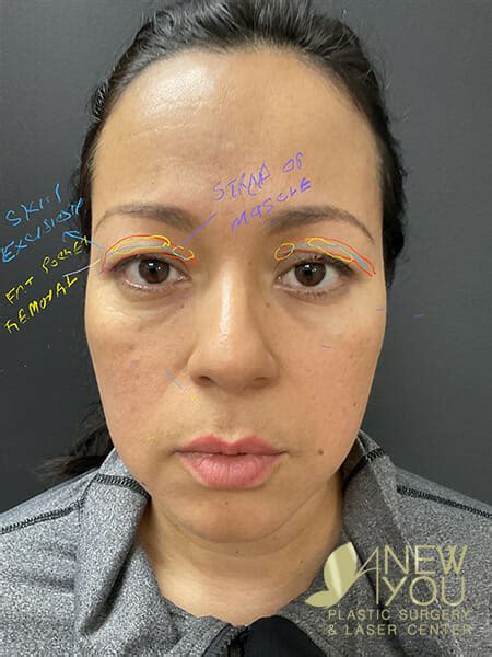 Do You Need Blepharoplasty What Is Blepharoplasty