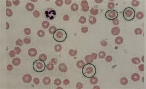 Clin Path Set Clin Path Set Flashcards Quizlet