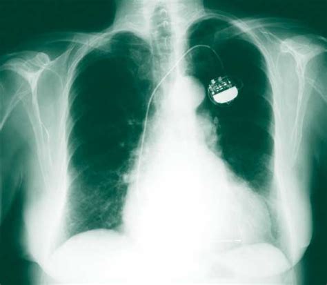 Complete Section Of Pacemaker Lead Due To Subclavian Crush The Medical Journal Of Australia