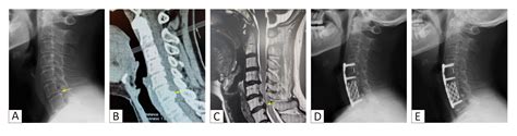 Anterior Cervical Hybrid Decompression And Fusion Surgery To Treat