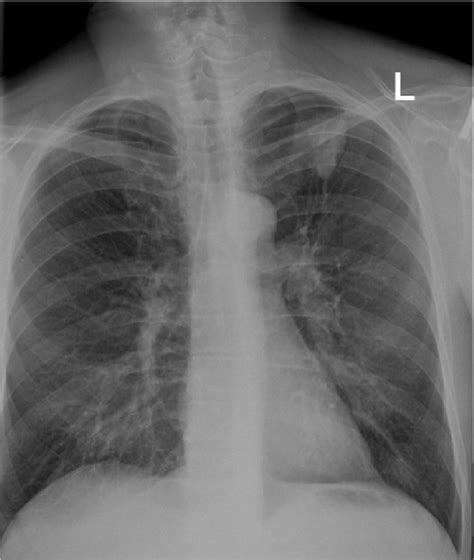 A Generic Approach To Lung Field Segmentation From Chest Radiographs