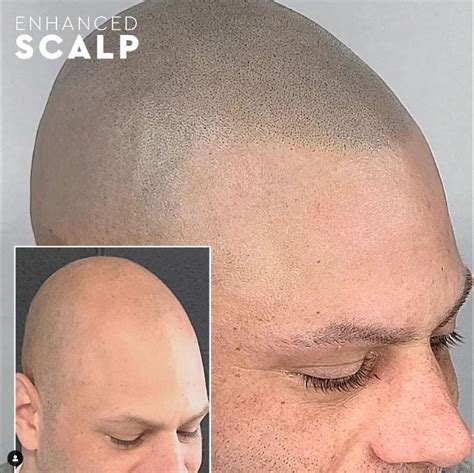 Scalp Micropigmentation Results Gallery Enhanced Scalp