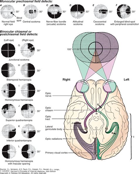 Visual Field Defects Chart Ponasa