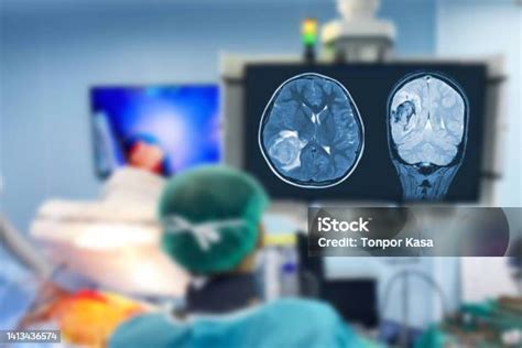 수술실에서 흐릿한 클로즈업 백 샷 어시스턴트는 뇌종양 수술 중 외과의에게 장비를 나눕니다 외과 의사는 수술을 수행합니다 수술에 대한 스톡 사진 및 기타 이미지 Istock