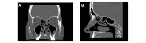 Ethmoid Air Cells Opacified