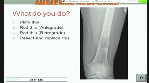 Pathologic Fracture X Ray