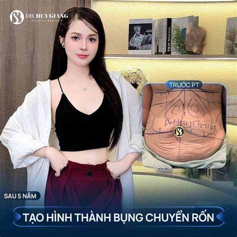 Siết Eo Sau Sinh Sồ Sề Thon Gọn Tức Thì Dr Huy Giang