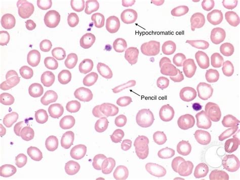 Iron Deficiency Anemia