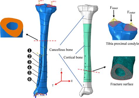 The Finite Element Analysis Model Of Tibia Download Scientific Diagram