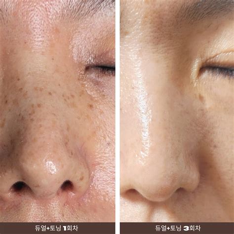 기미 주근깨 잡티 점 피부 깨끗한 피부로 변신 경상북도 구미시 인동동 비즈프로필