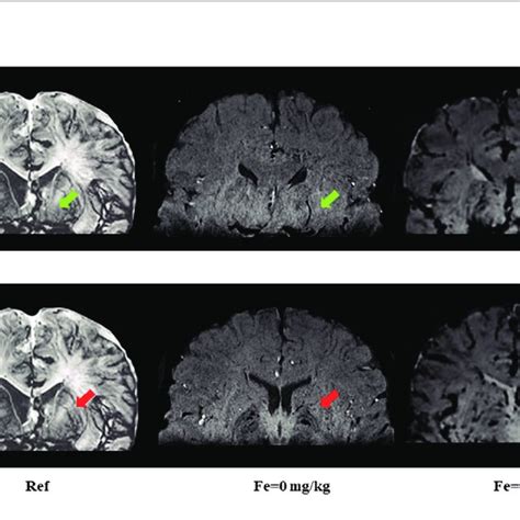 Distribution Of White Matter Hyperintensities Wmh Severity In