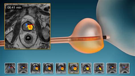 Tulsa Pro Prostate Cancer Treatment