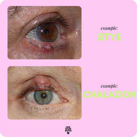 Breaking Down Stye Versus Chalazion In Simple Terms We Love Eyes