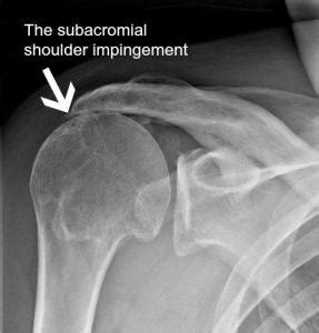 Subacromial Impingement Syndrome Physiocure