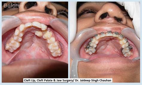 Cleft Lip Cleft Palate And Jaw Surgery Dr Jaideep Singh Chauhan 09