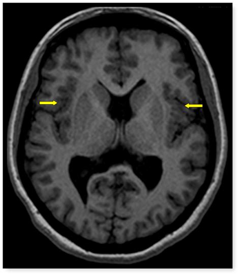 Septo Optic Dysplasia Plus Syndrome With Bilateral Perirolandic And Perisylvian Polymicrogyria