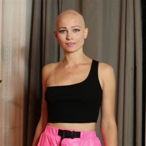 Abby Andrew Biography American Woman Suffering From Alopecia Areata