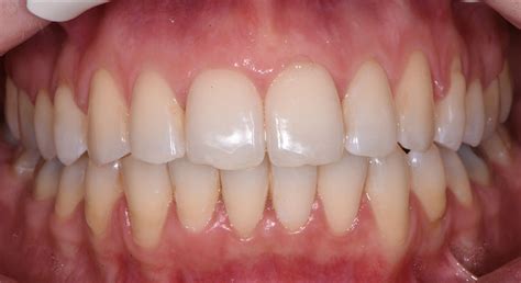 Ортодондия и брекети Деймън Roi Dental Clinic