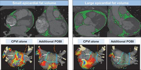 Measurement Of Epicardial Adipose Tissue Volume Using 3 Dimensional
