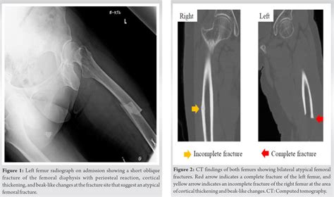 Impending Atypical Femoral Fracture On The Contralateral Side