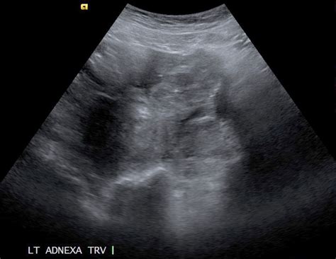 Pathology Outlines Ectopic Tubal Pregnancy