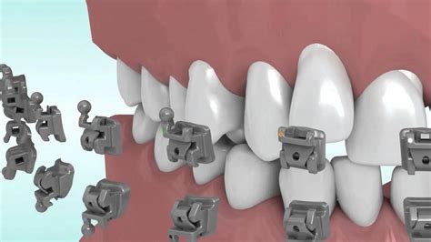 Bráquete Metálico Autoligado Morelli Dental Speed Youtube