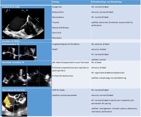 Contemporary Approach To Tricuspid Regurgitation Knowns Unknowns And