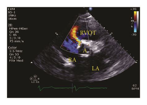 Post Tavr Day 1 Tte 2d Echo Short Axis View Shows Color Flow Jet From