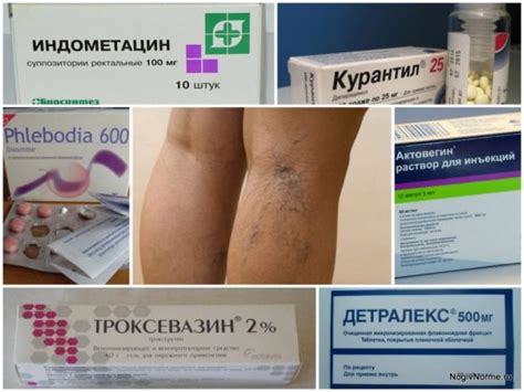 Лечение варикоза вен на ногах медицинскими препаратами - обзор лучших ...
