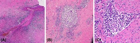 Granuloma Formation Is Insufficient For Differentiating Hidradenitis