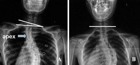 Two Different Kinds Of Proximal Thoracic Pt Curve A Complete Pt