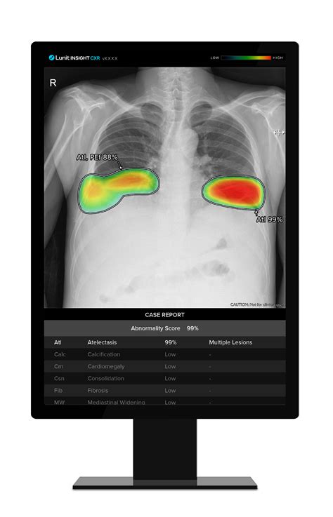 Lunit And Samsung Integrate To Power Ai Powered Chest Screenings