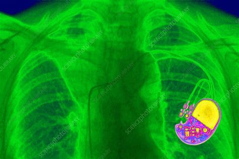 Pacemaker X Ray Stock Image C045 8250 Science Photo Library