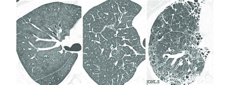 Ct Patterns Of Interlobular Septal Thickening Thickening Of