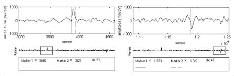 Signal Mal 64 With Two Motion Artefacts Detected By Cwt Download Scientific Diagram