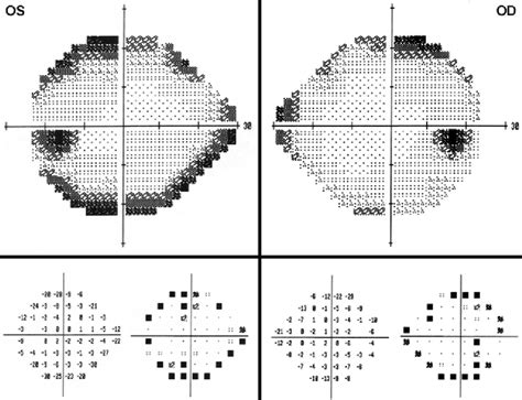 Automated Static Perimetry Humphrey 24 2 Sita Standard Test Gray Download Scientific Diagram