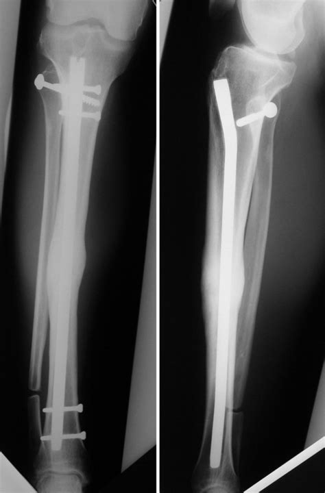 Proximal Tibiofibular Dislocation Associated With Fracture Of The Tibia