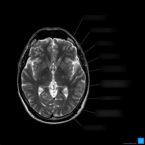 Brain Axial Mri T2 Caudate Nucleus Level Diagram Quizlet