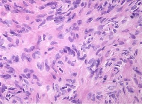 Microscopic Appearance Of Dfsp 6 Download Scientific Diagram
