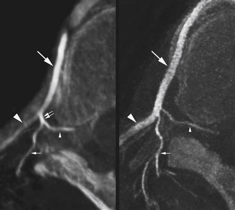 Arterial Anatomy Of The Spine And Spinal Cord Clinical Tree