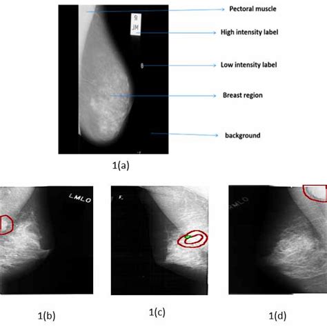 A Different Parts Of Mammogram B Abnormality Marked In The Download Scientific Diagram