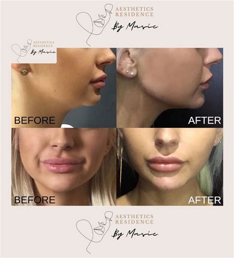 Facial Reshaping Sydney Gummy Smiles Face Slimming